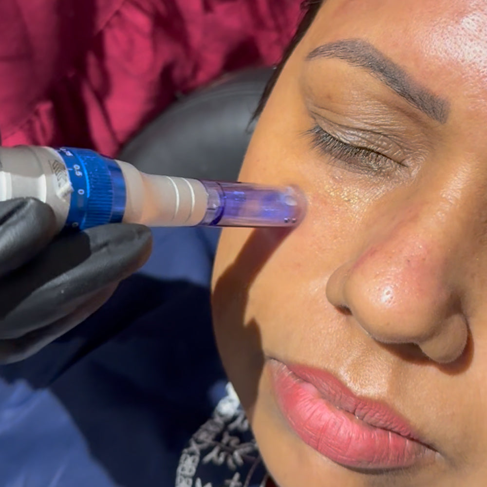 MICRONEEDLING – 360aesthetic